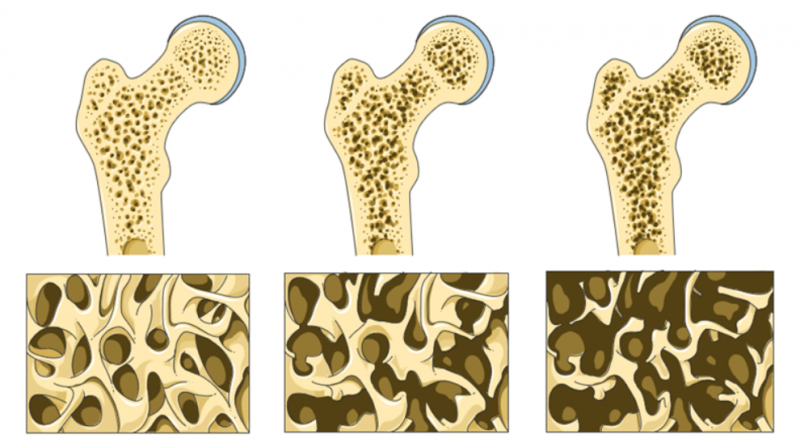 The Link between Bone Density and Breast Cancer Risk