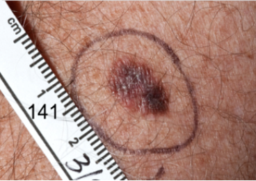 From Moles to Melanoma: The ABCDE Rule for Identifying Melanoma Skin ...